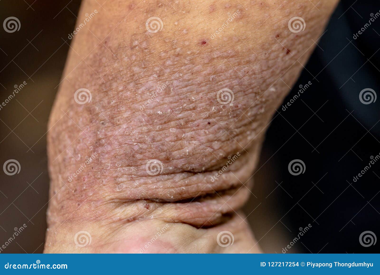 Study of Physical of Atopic Dermatitis AD, Also Known As Atopic Eczema ...