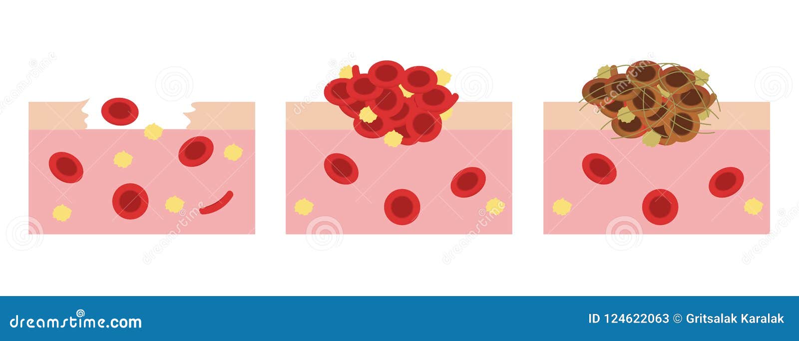 Piastrina E Fibrina Sulla Ferita Illustrazione Vettoriale ...