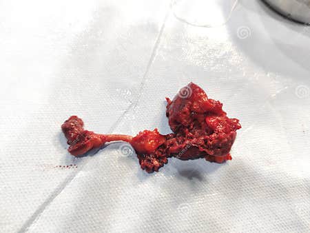 Appendix Removed from a Patient after Necrotizing Appendectomy Stock ...