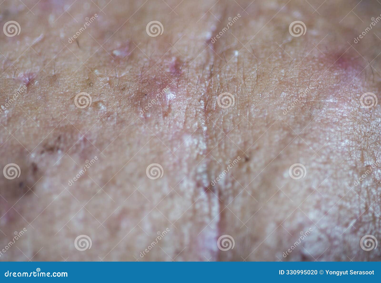 Picture of the Problem of Bumps and Red Rashes on the Skin on the Human ...