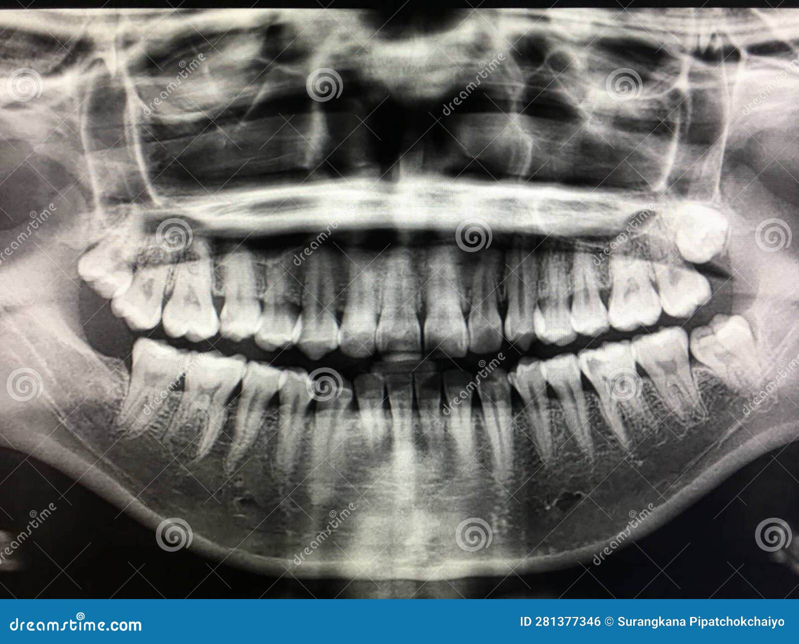 Picture of 32 Teeth Tooth Bone Dental Care Teeth Care Stock Photo ...