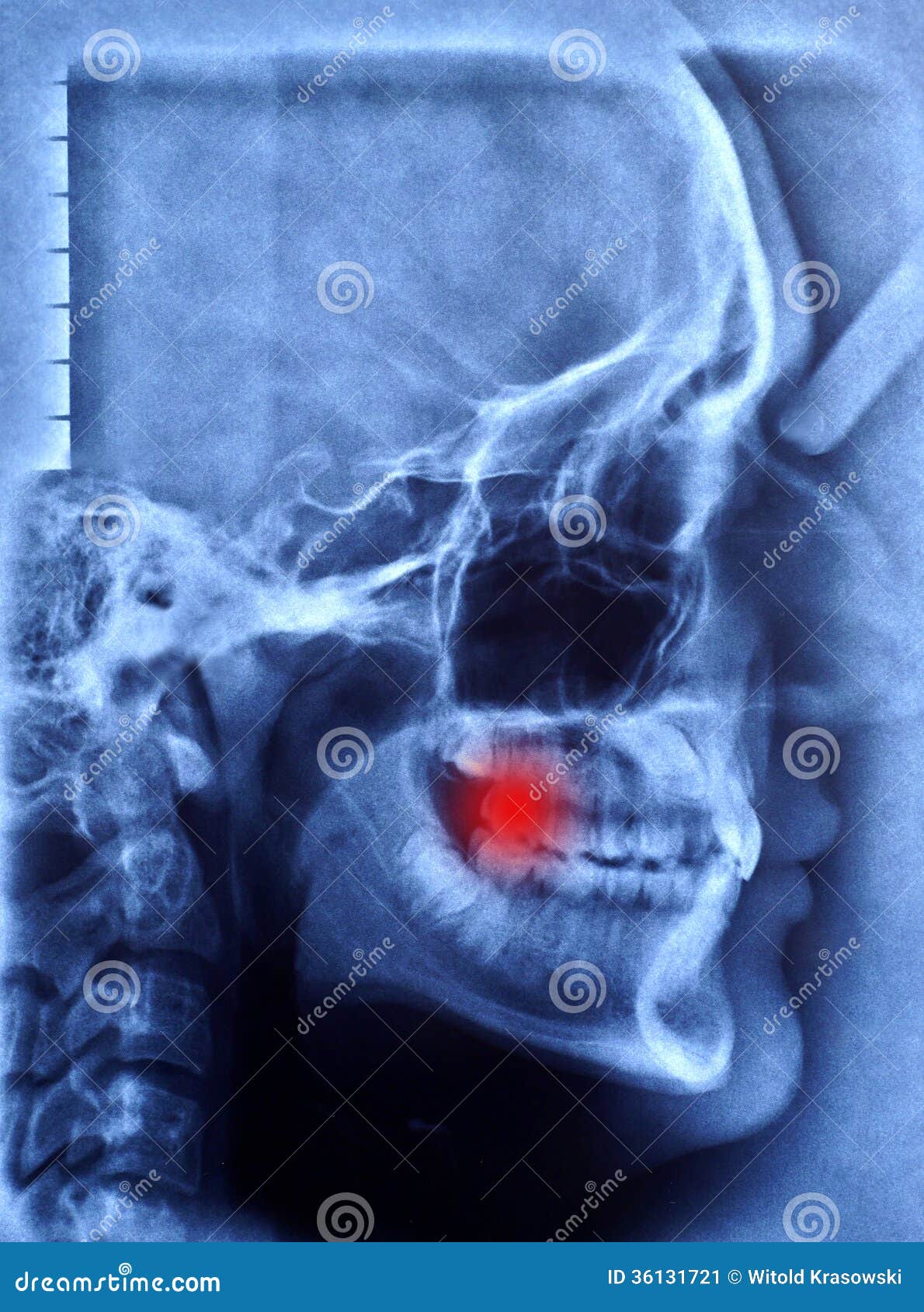 Human Skull On Clear Blue Background. Open Skull Without Lower Jaw ...