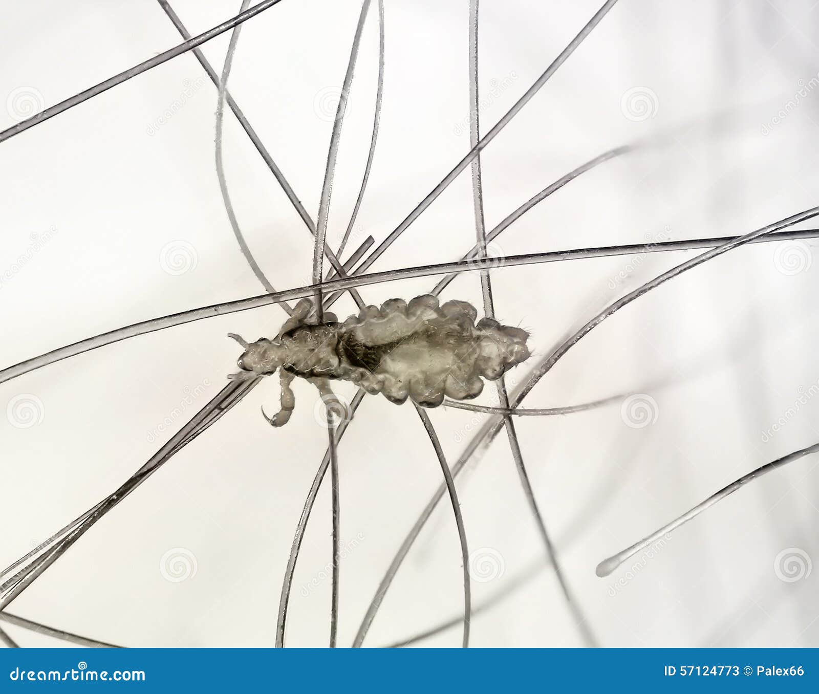 Pidocchi Del Capo (pidocchio) Immagine Stock - Immagine di medico ...