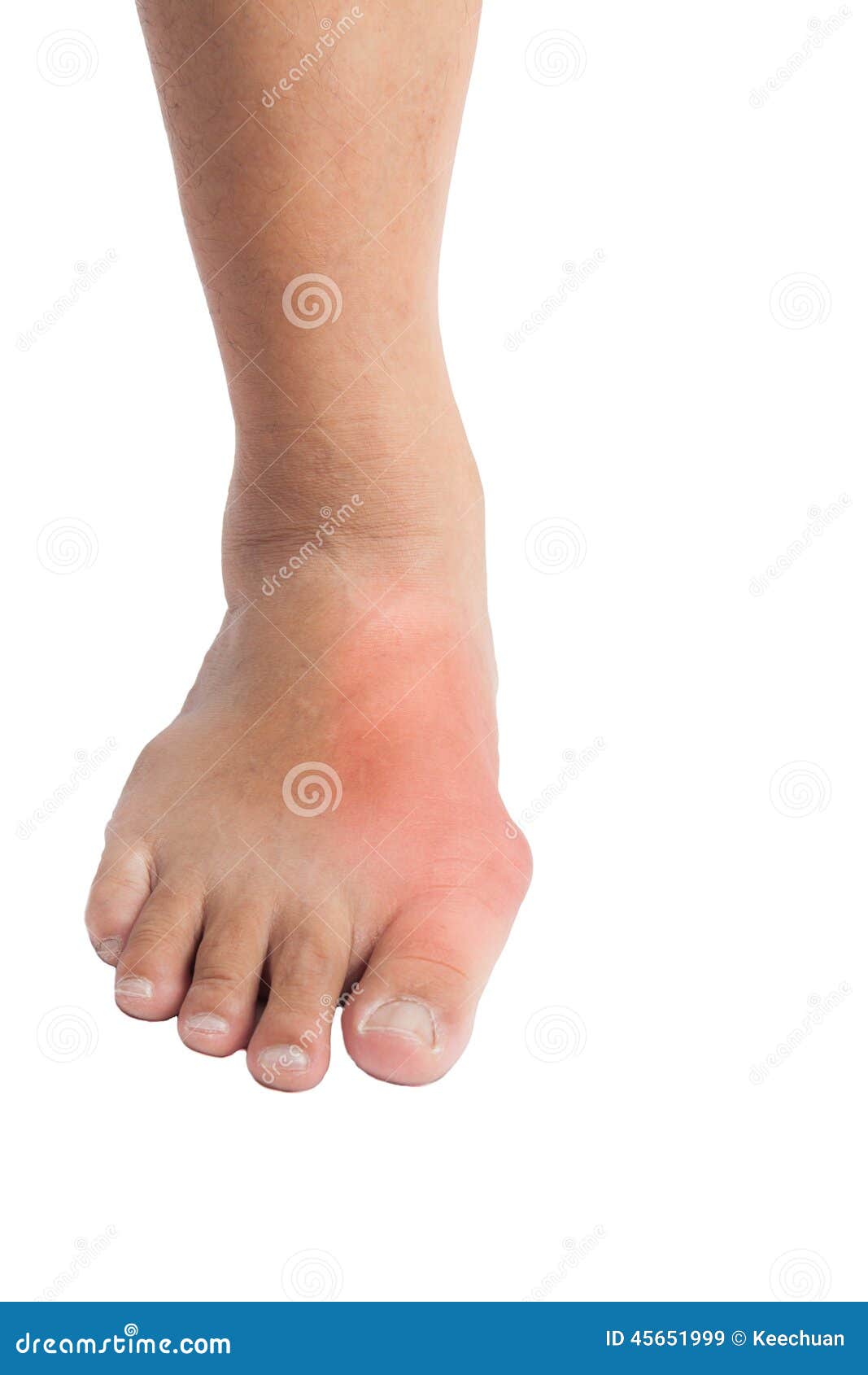 Pie Deformado Con La Inflamación De La Gota Imagen de archivo - Imagen ...