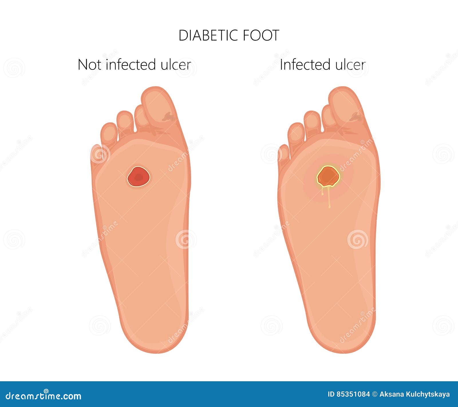 Pie Diabético Con La úlcera Infectada Ilustración del Vector ...