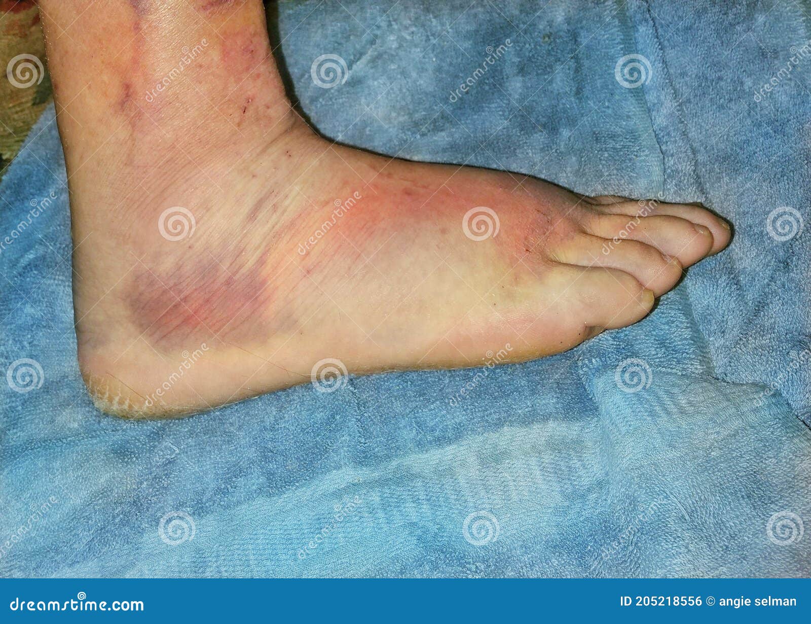 Pie Rojo Hinchado Y Magullado Foto de archivo - Imagen de pierna, cara ...