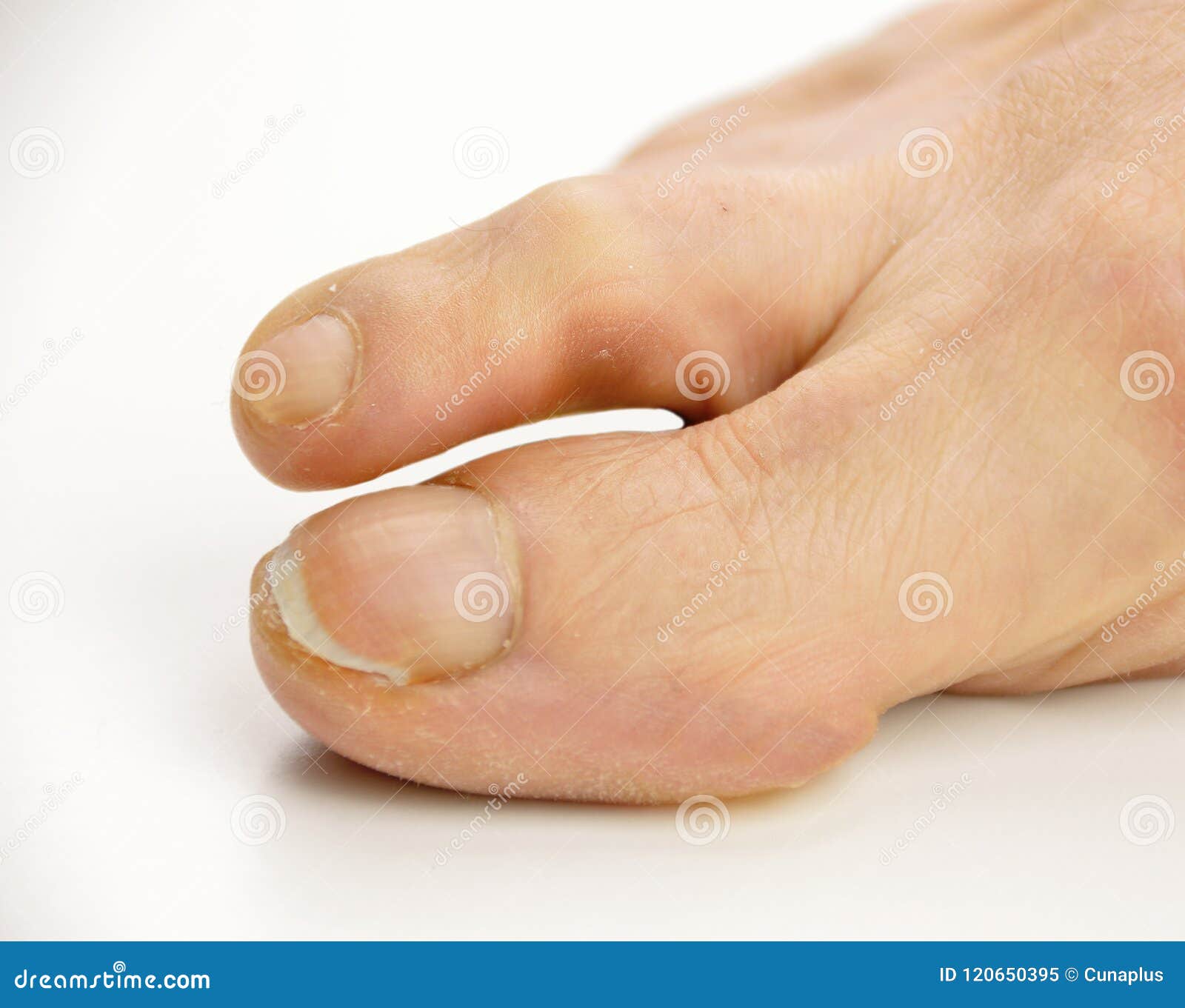 Piede con i calli immagine stock. Immagine di duro, barretta - 120650395