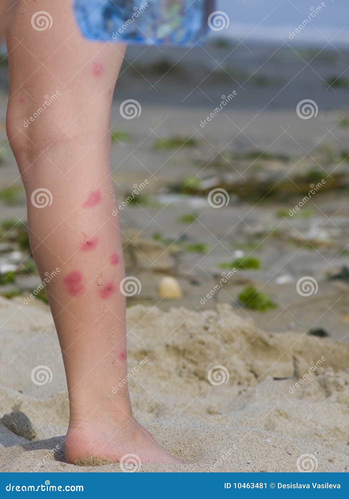 Piel Infectada De Un Mosquito Imagen de archivo - Imagen de claveteado ...