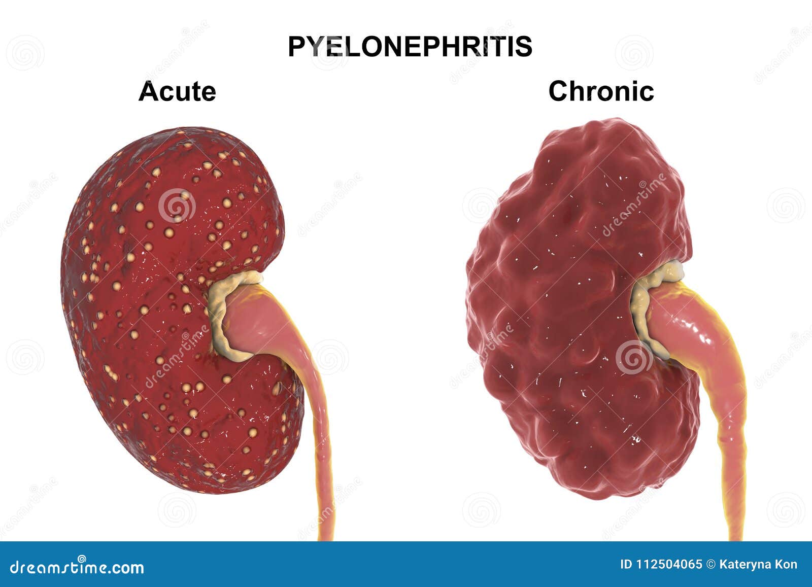 Pielonefrite Acuta E Cronica, Concetto Medico Illustrazione di Stock ...
