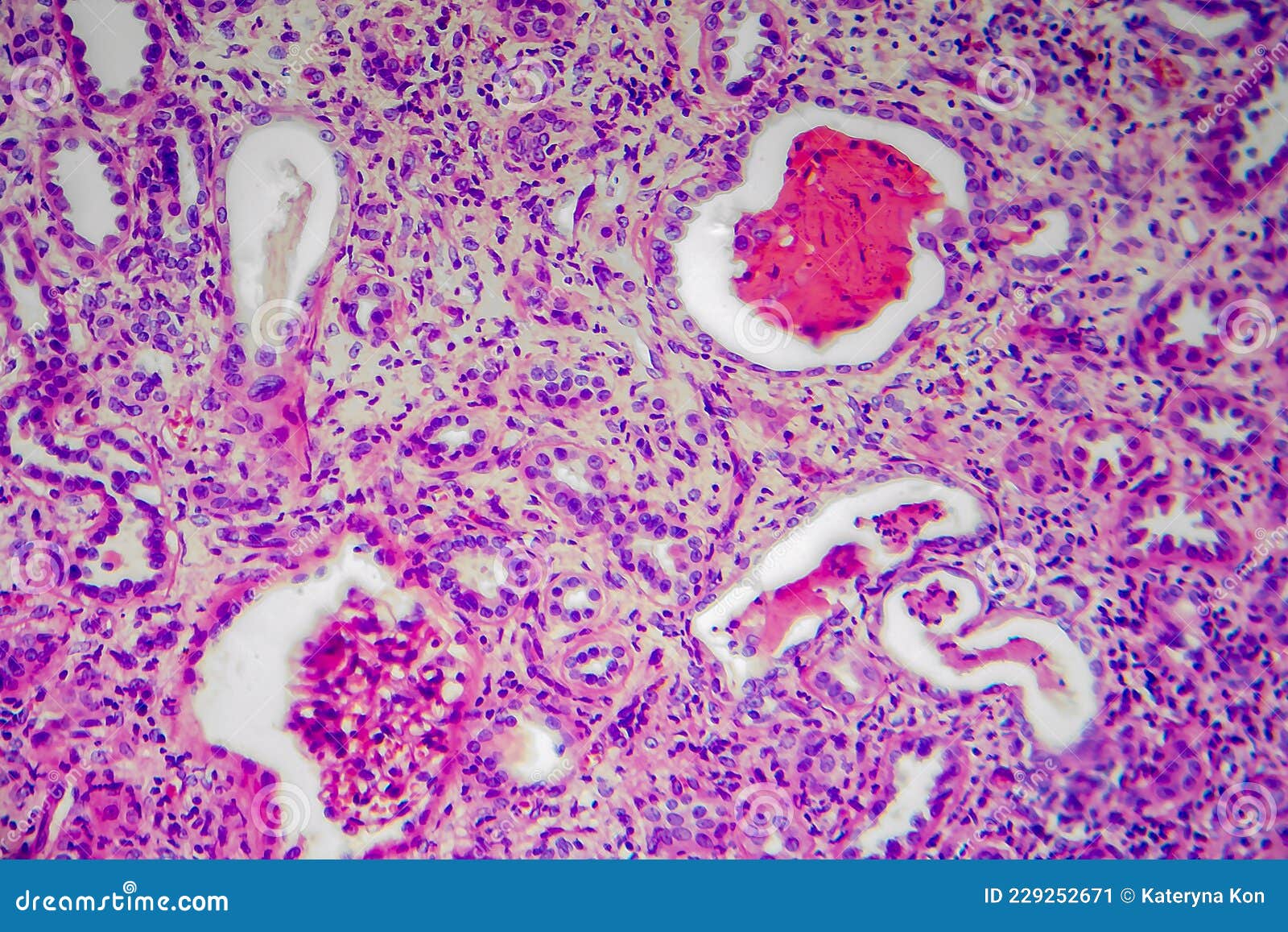 Pielonefrite Cronica: Micrografo Luminoso Immagine Stock - Immagine di ...