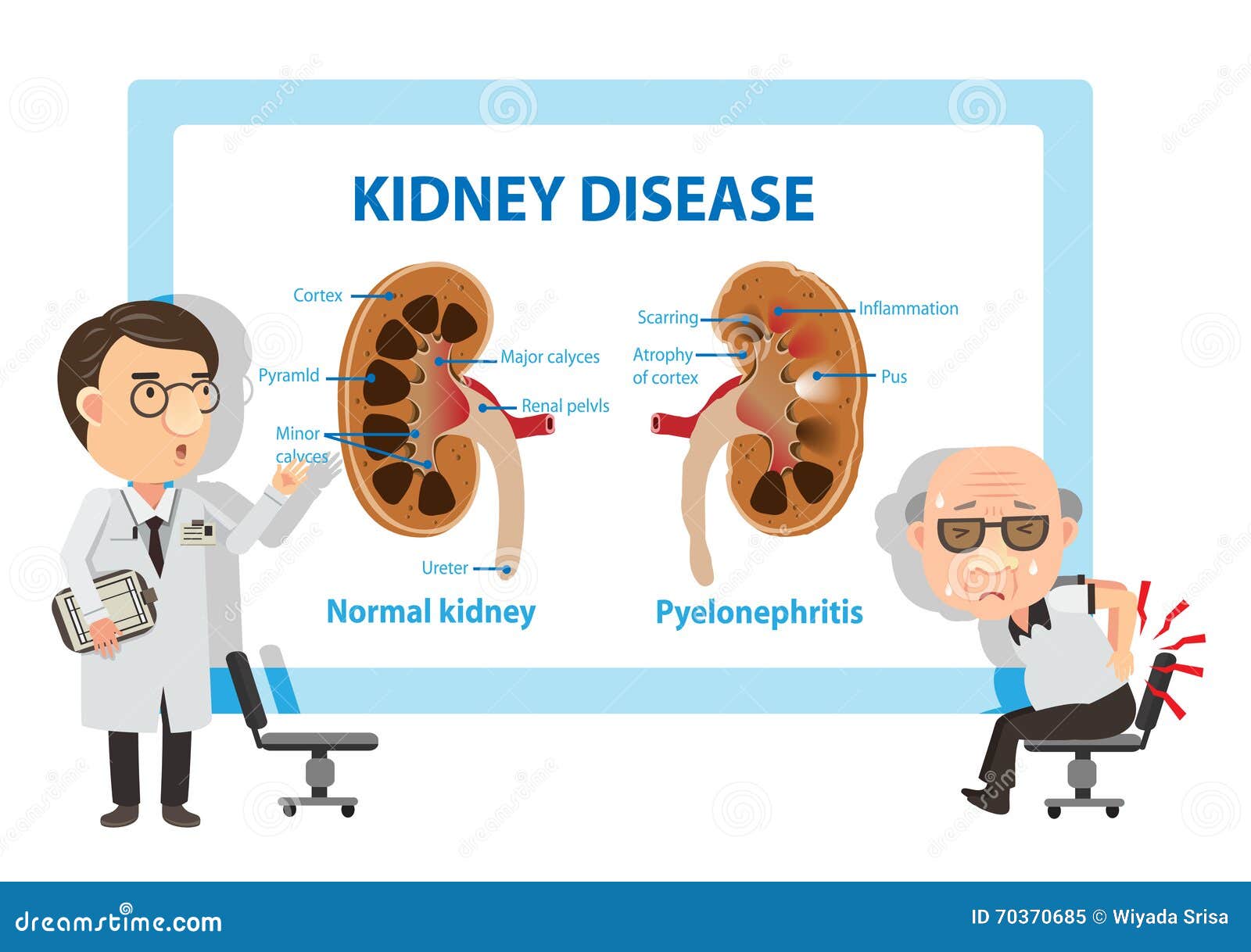Pielonefritis ilustración del vector. Ilustración de paciente - 70370685