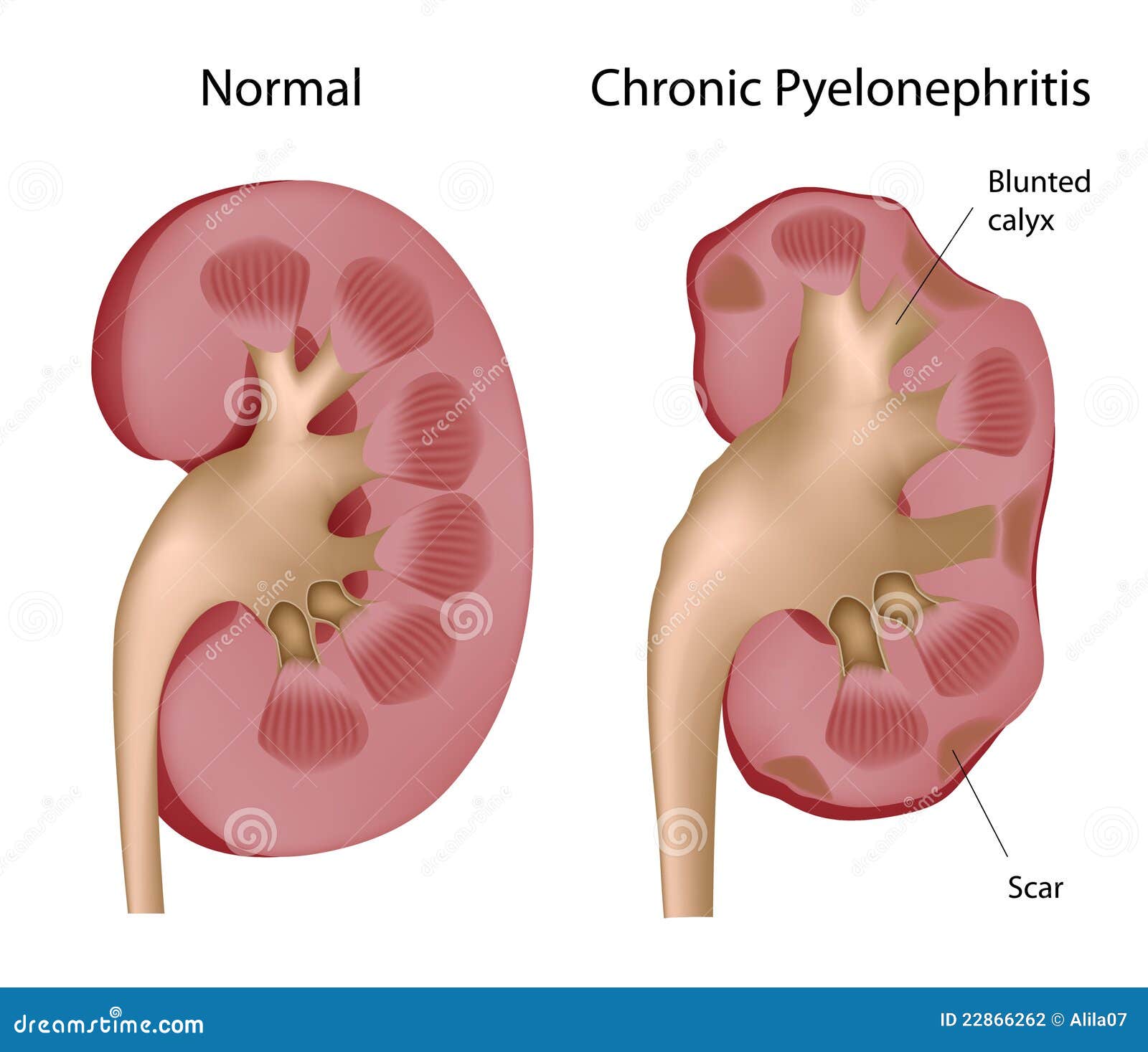 Pielonefritis Crónica Del Riñón Fotografía de archivo - Imagen: 22866262