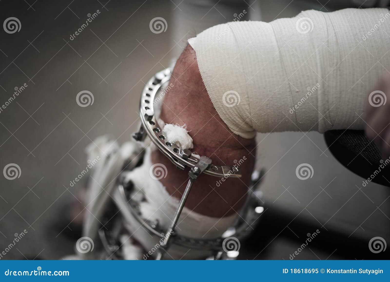 Pierna quebrada imagen de archivo. Imagen de detalle - 18618695