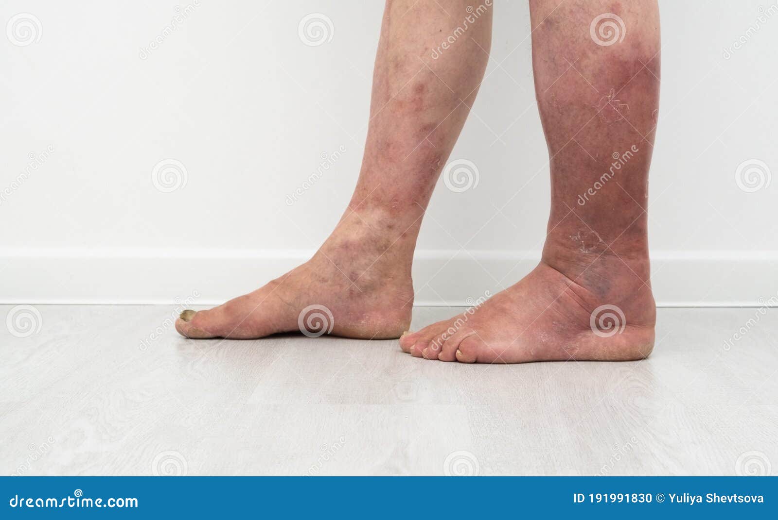 Piernas Con Linfotasis Y Psoriasis. Foto de archivo - Imagen de cuidado ...