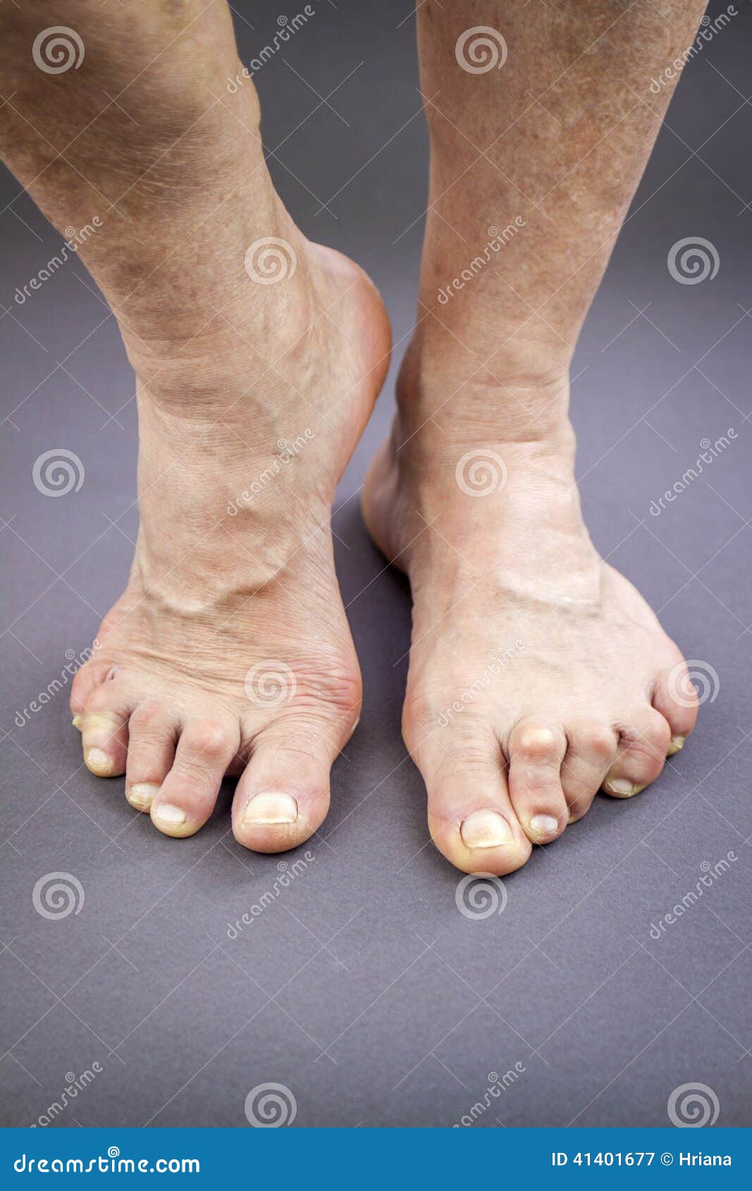 Pies De La Artritis Reumatoide Imagen de archivo - Imagen de artritis ...