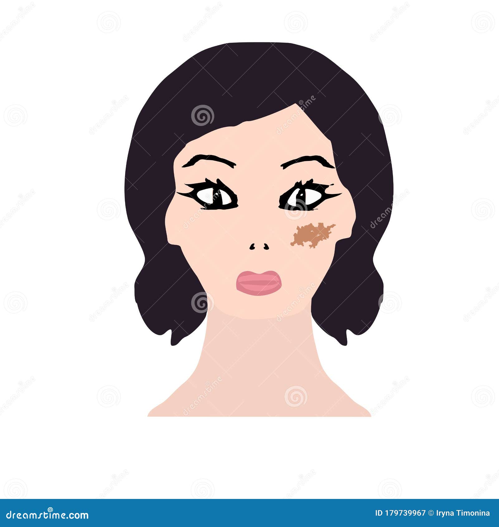 Pigmentation on the Skin. a Pigmented Spot on the Skin of the Face ...