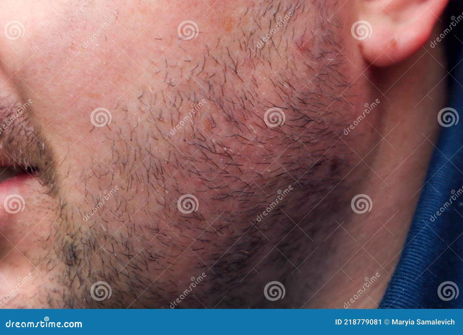 Pigmentation Spots on the Cheek of a Young Man among the Overgrown ...