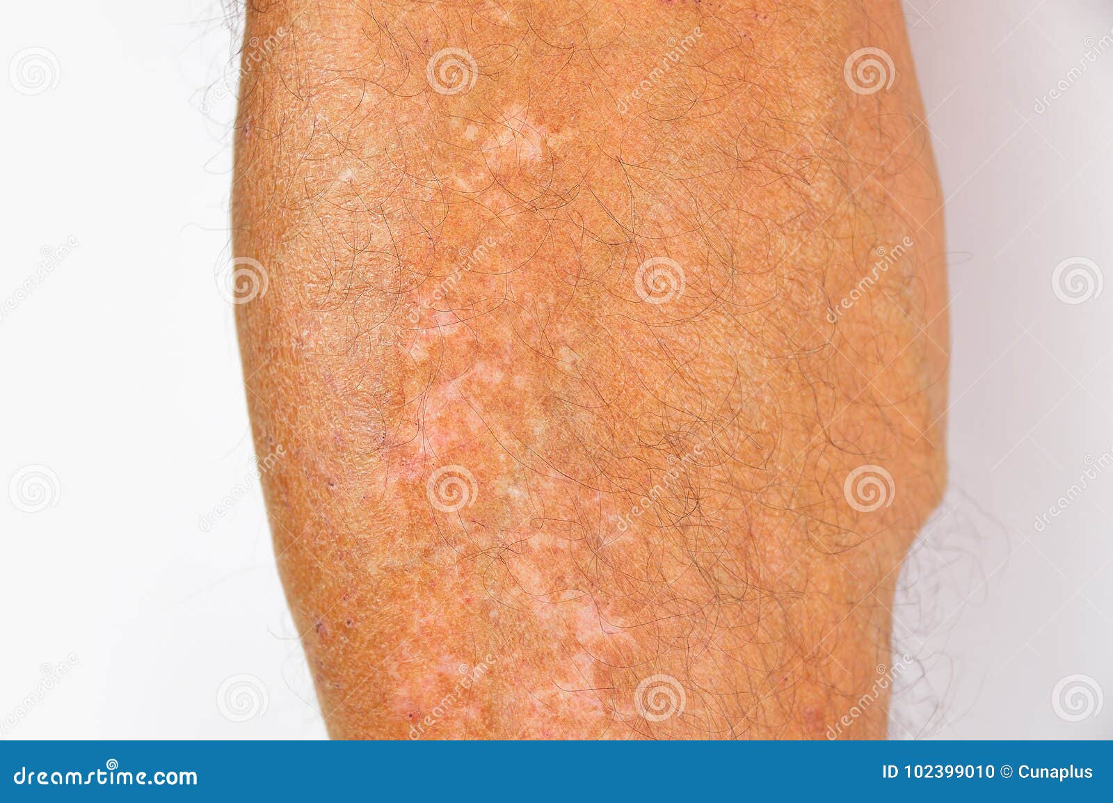 Pigmentation Sur Des Jambes Photo stock - Image du médical, eczéma ...