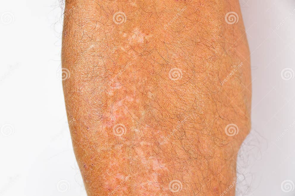 Pigmentation Sur Des Jambes Photo stock - Image du médical, eczéma ...
