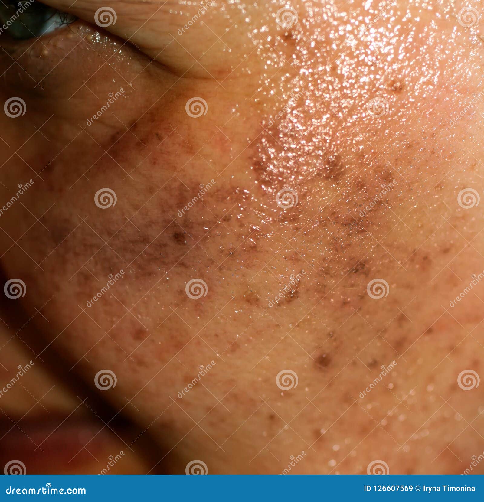 Pigmented Spots on the Face. Pigmentation on Cheeks Stock Image - Image ...