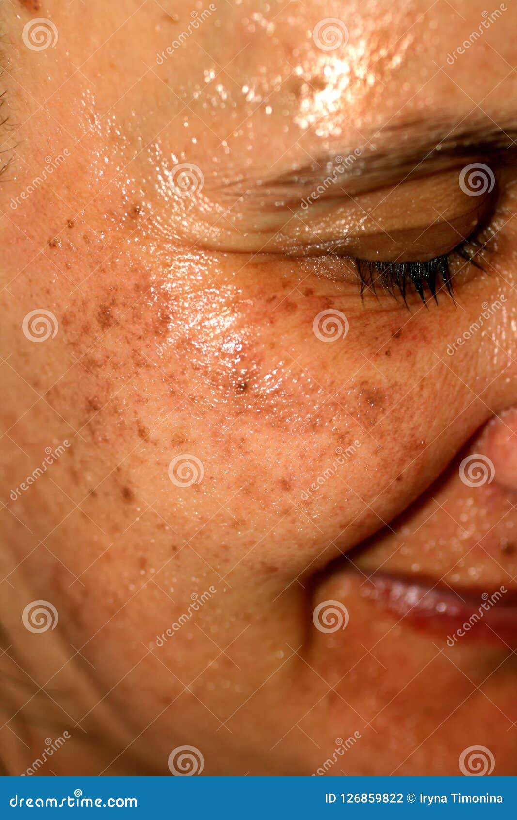 Pigmented Spots on the Face. Pigmentation on Cheeks Stock Photo - Image ...