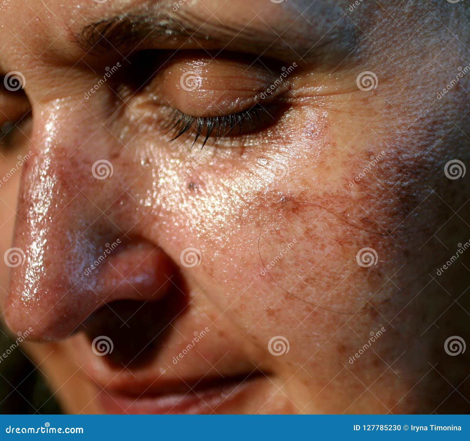 Pigmented Spots on the Face. Pigmentation on Cheeks Stock Photo - Image ...