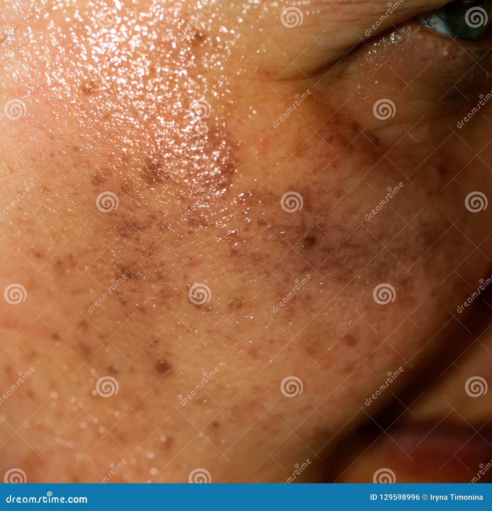 Pigmented Spots on the Face. Pigmentation on Cheeks Stock Photo - Image ...