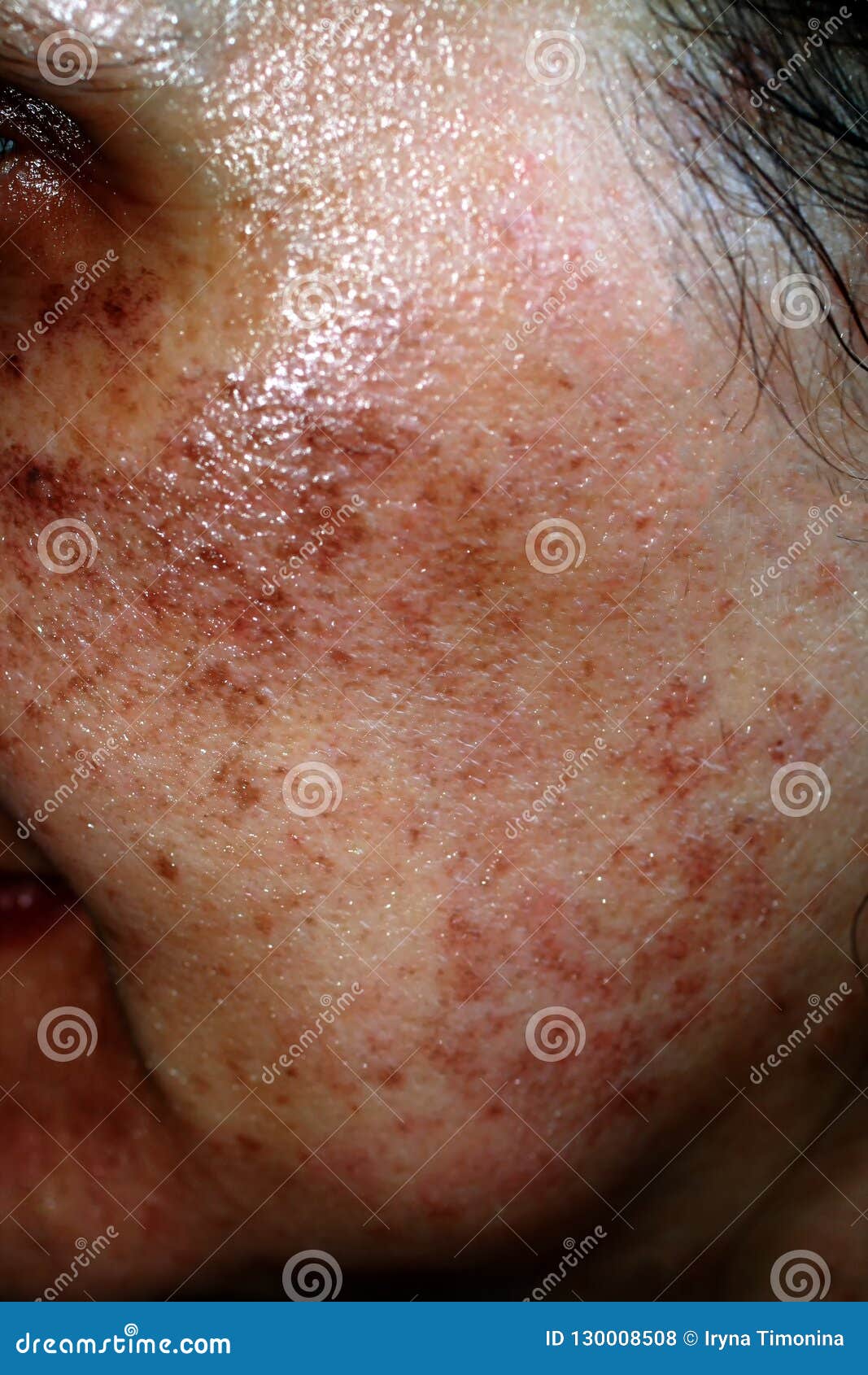 Pigmented Spots on the Face. Pigmentation on Cheeks Stock Photo - Image ...