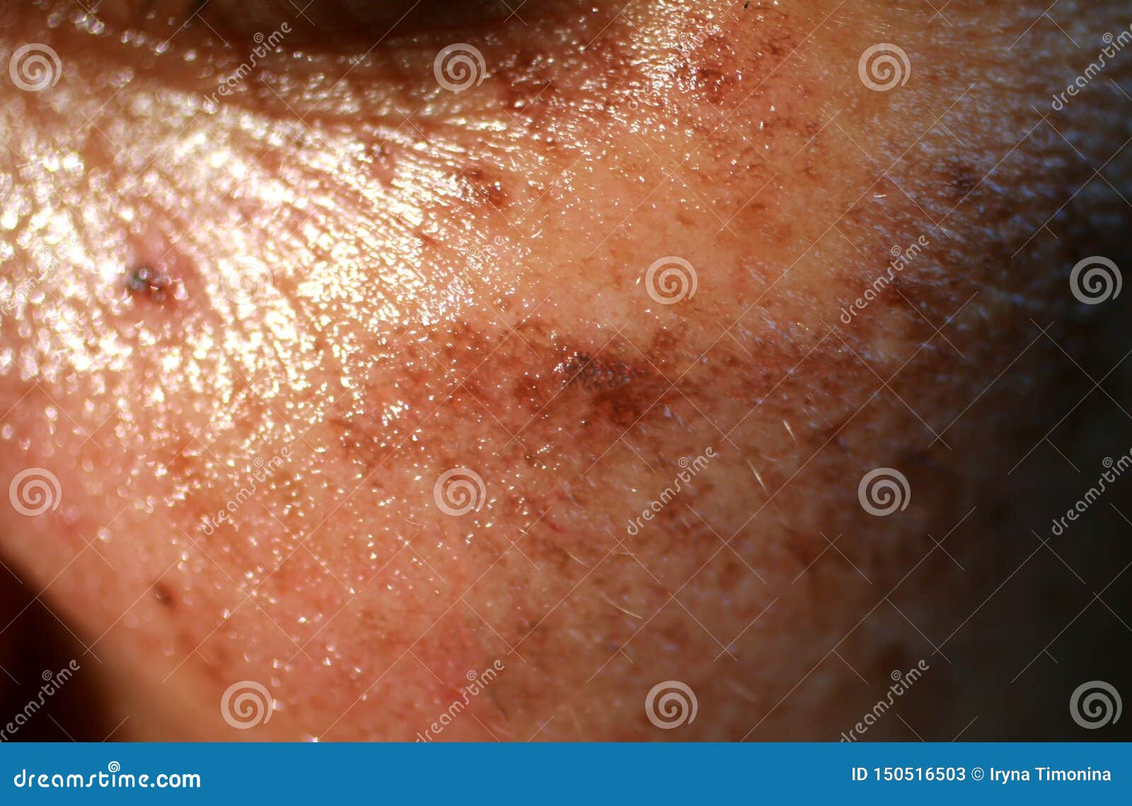 Pigmented Spots on the Face. Pigmentation on Cheeks Stock Image - Image ...