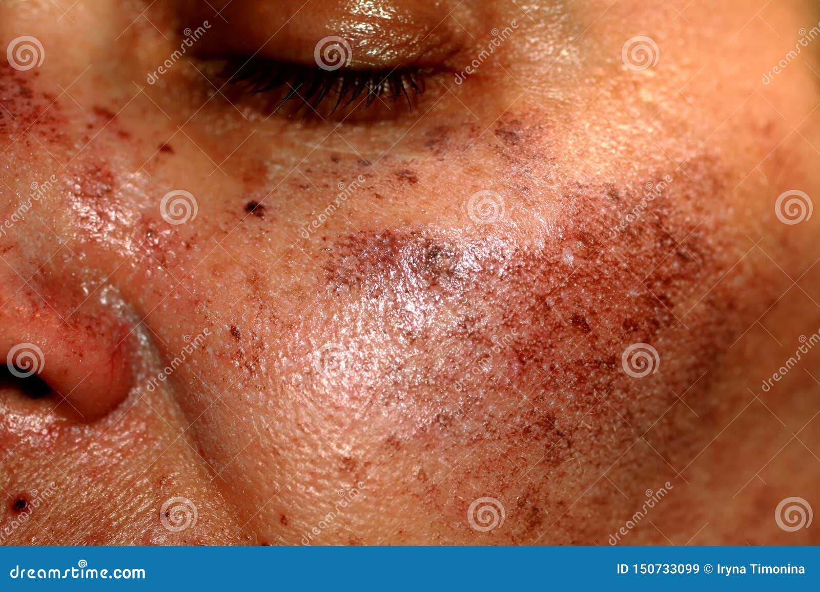 Pigmented Spots on the Face. Pigmentation on Cheeks Stock Image - Image ...