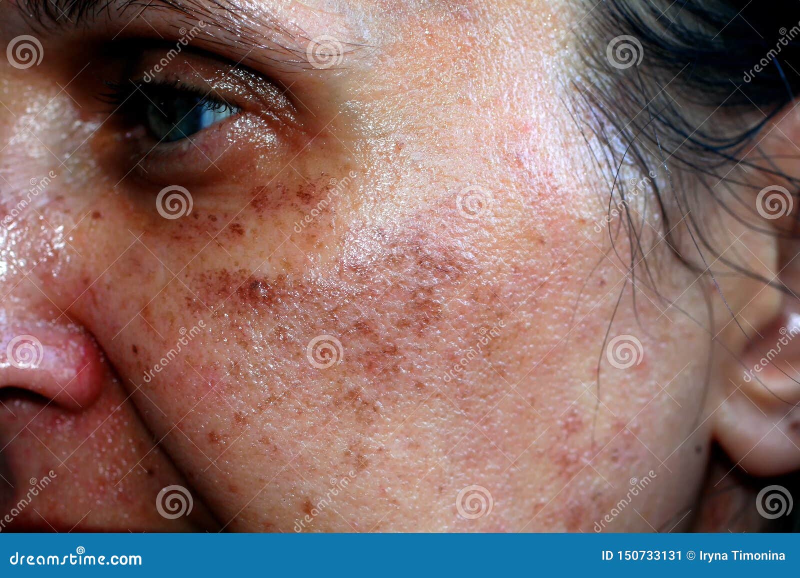 Pigmented Spots on the Face. Pigmentation on Cheeks Stock Image - Image ...