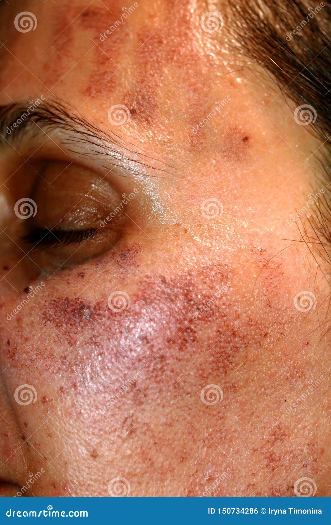Pigmented Spots on the Face. Pigmentation on Cheeks Stock Photo - Image ...