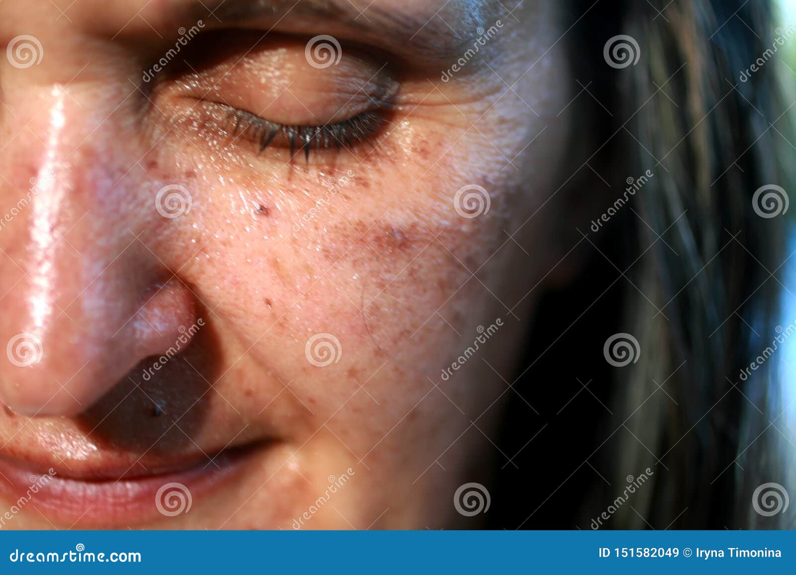Pigmented Spots on the Face. Pigmentation on Cheeks Stock Image - Image ...