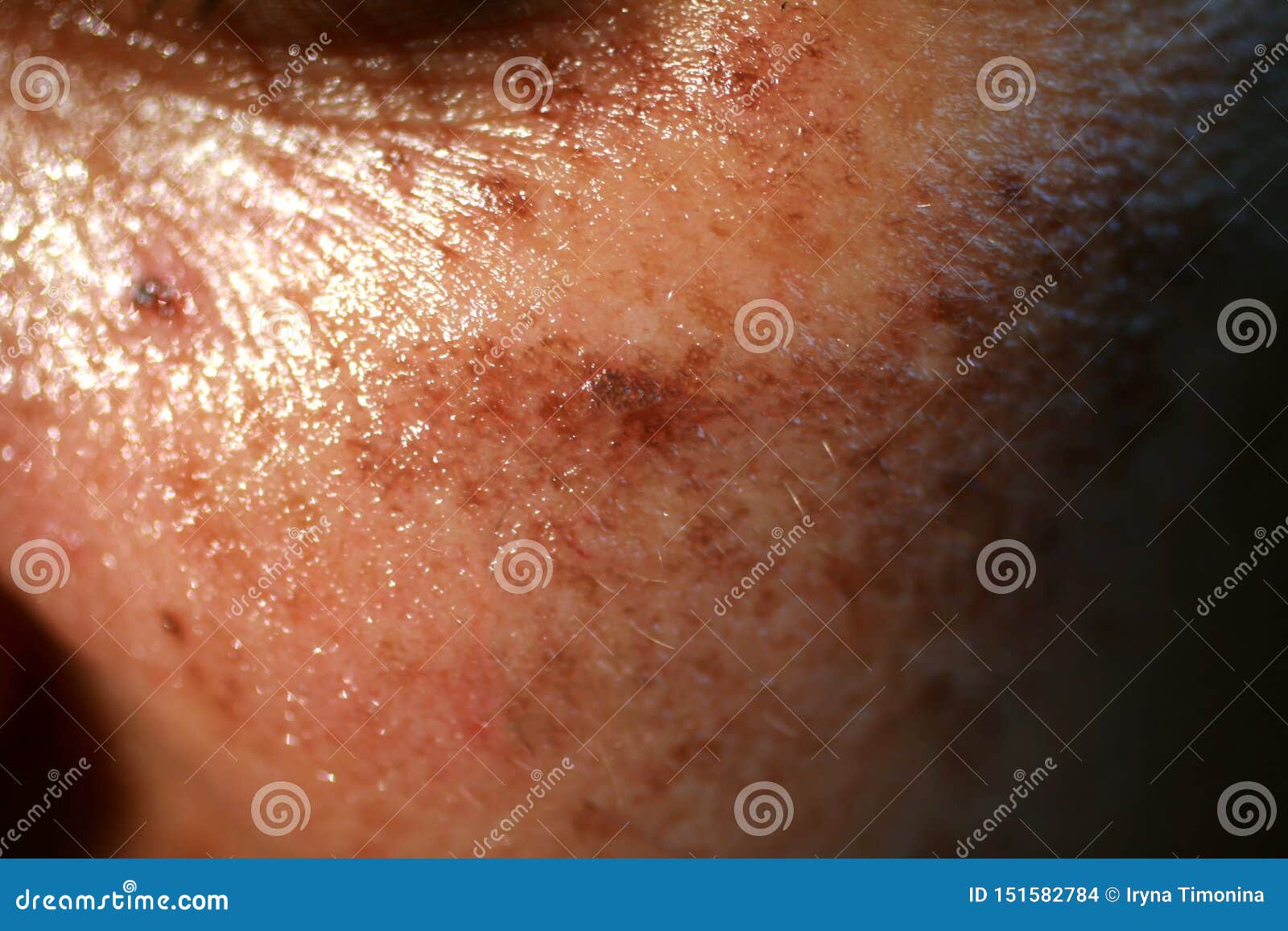 Pigmented Spots on the Face. Pigmentation on Cheeks Stock Photo - Image ...