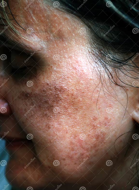 Pigmented Spots on the Face. Pigmentation on Cheeks Stock Photo - Image ...