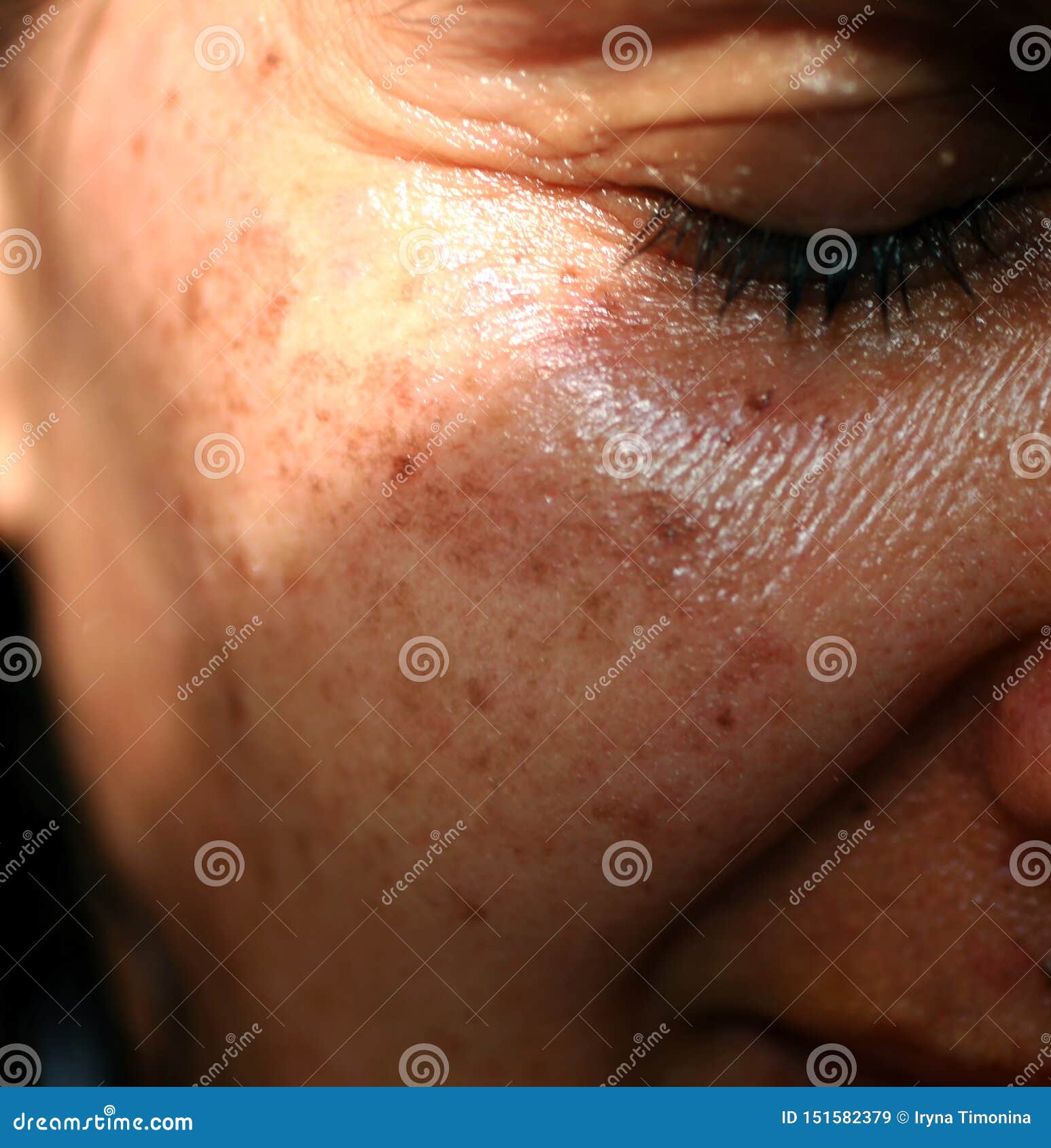 Pigmented Spots on the Face. Pigmentation on Cheeks Stock Image - Image ...