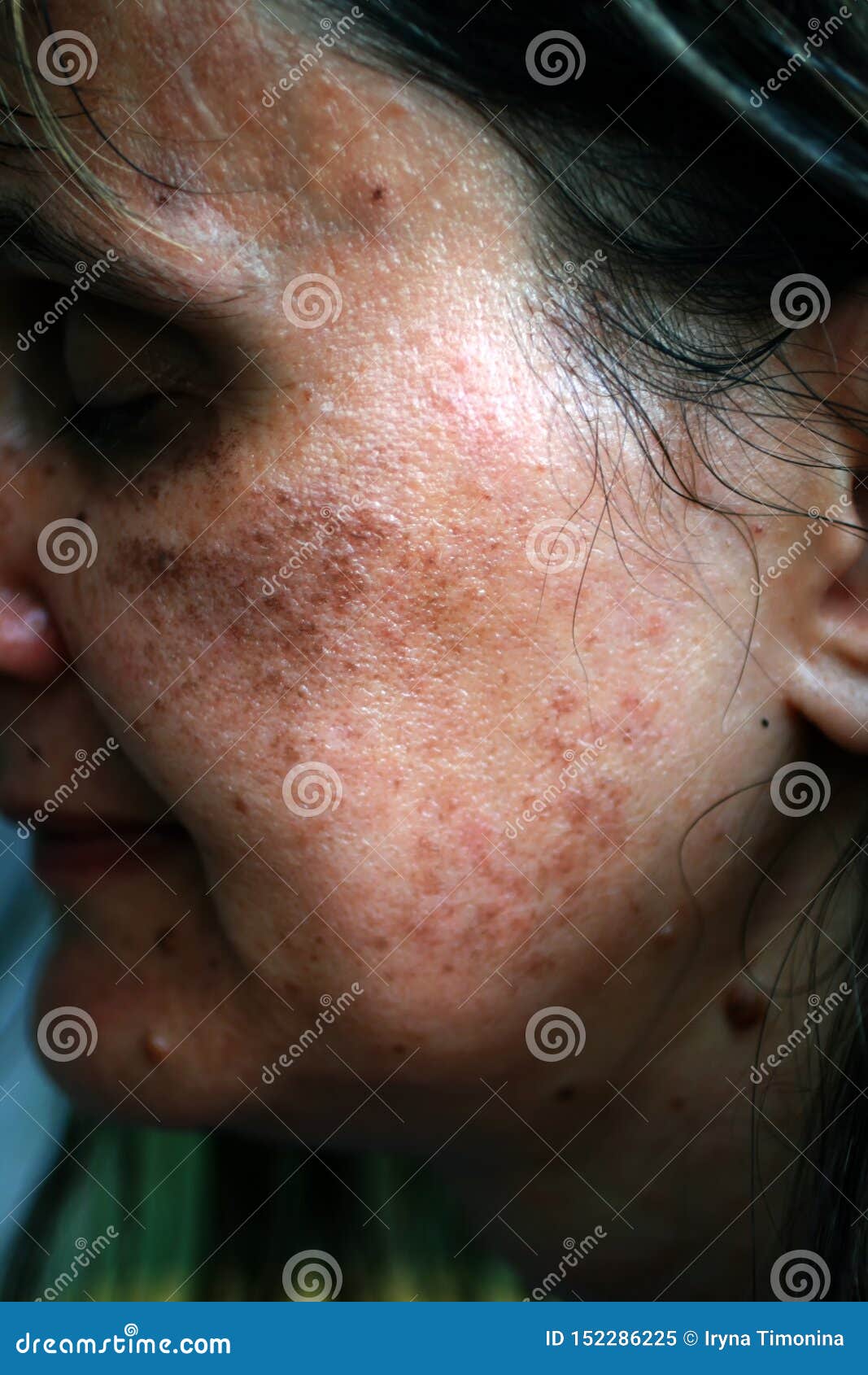 Pigmented Spots on the Face. Pigmentation on Cheeks Stock Image - Image ...