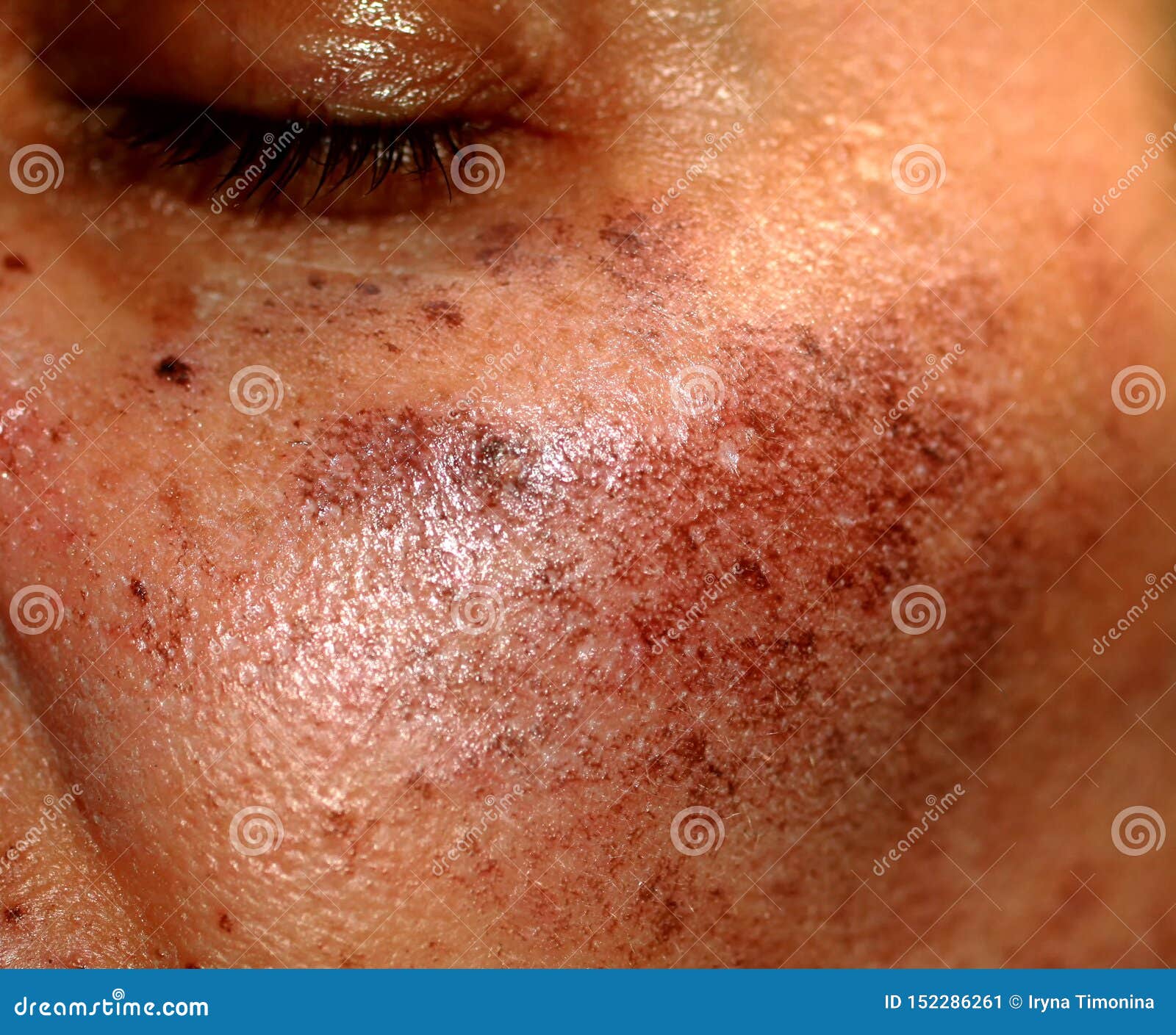 Pigmented Spots on the Face. Pigmentation on Cheeks Stock Image - Image ...
