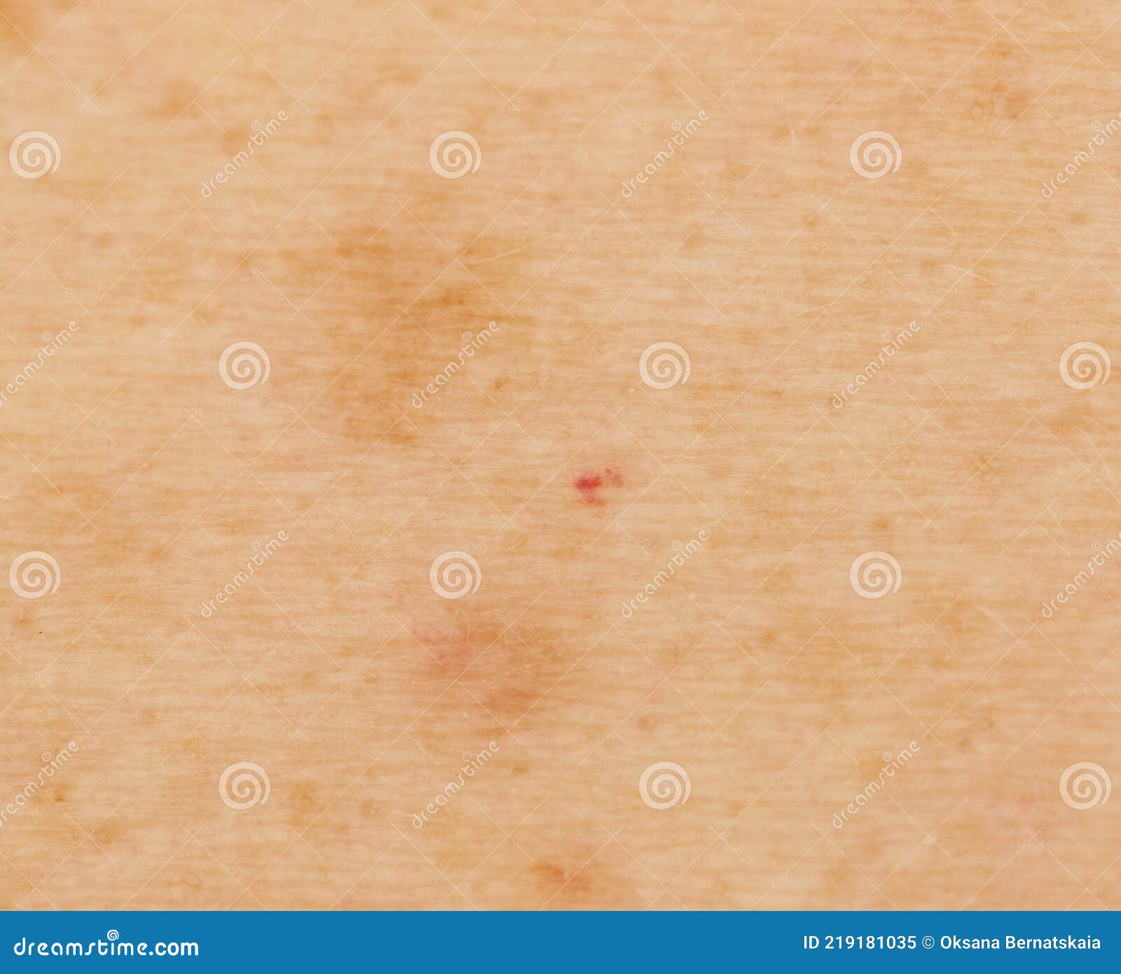 Pigmented Spots on the Skin Close-up Stock Image - Image of people ...