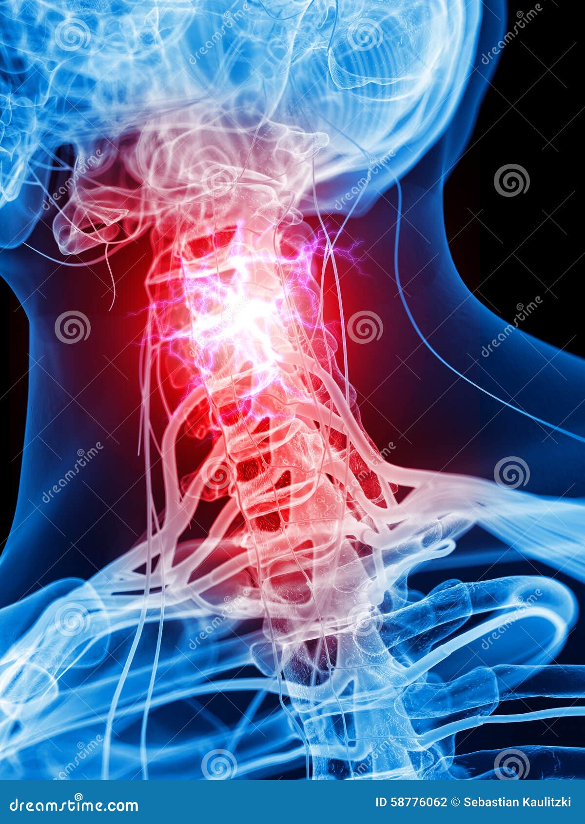 Pijnlijke Cervicale Zenuwen Stock Illustratie - Illustration of zwart ...