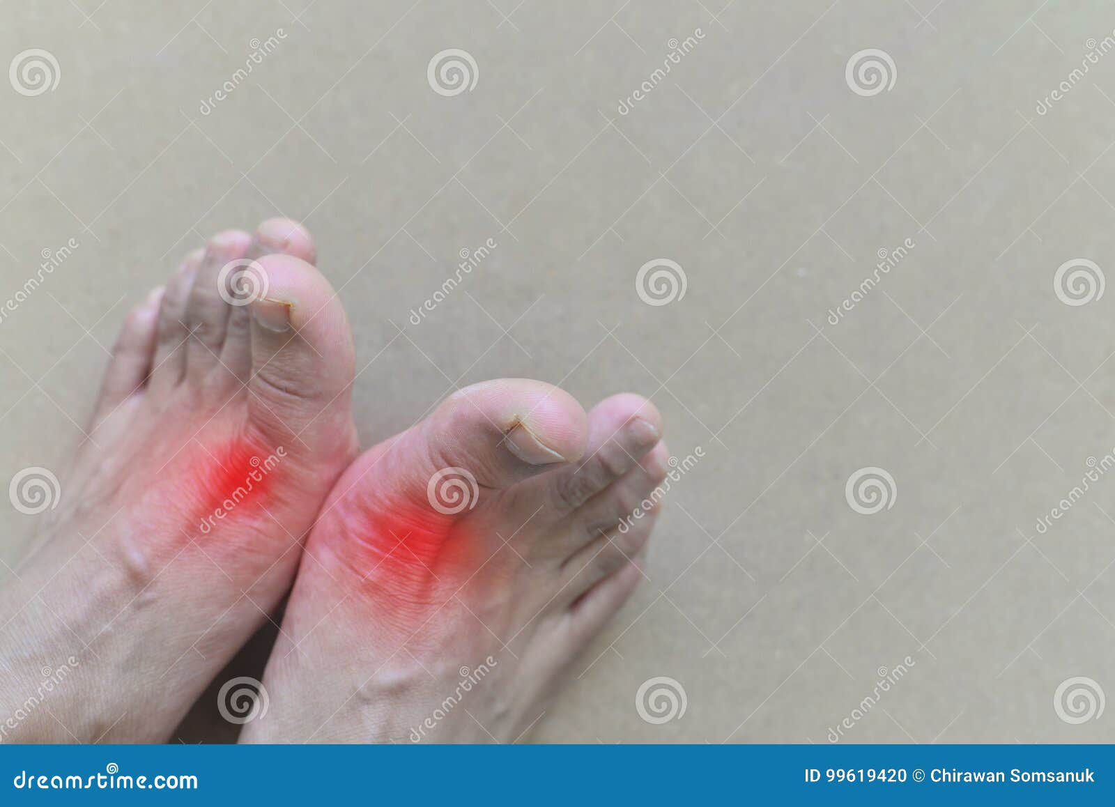 Pijnlijke En Ontstoken Jicht Stock Foto - Image of urine, medisch: 99619420