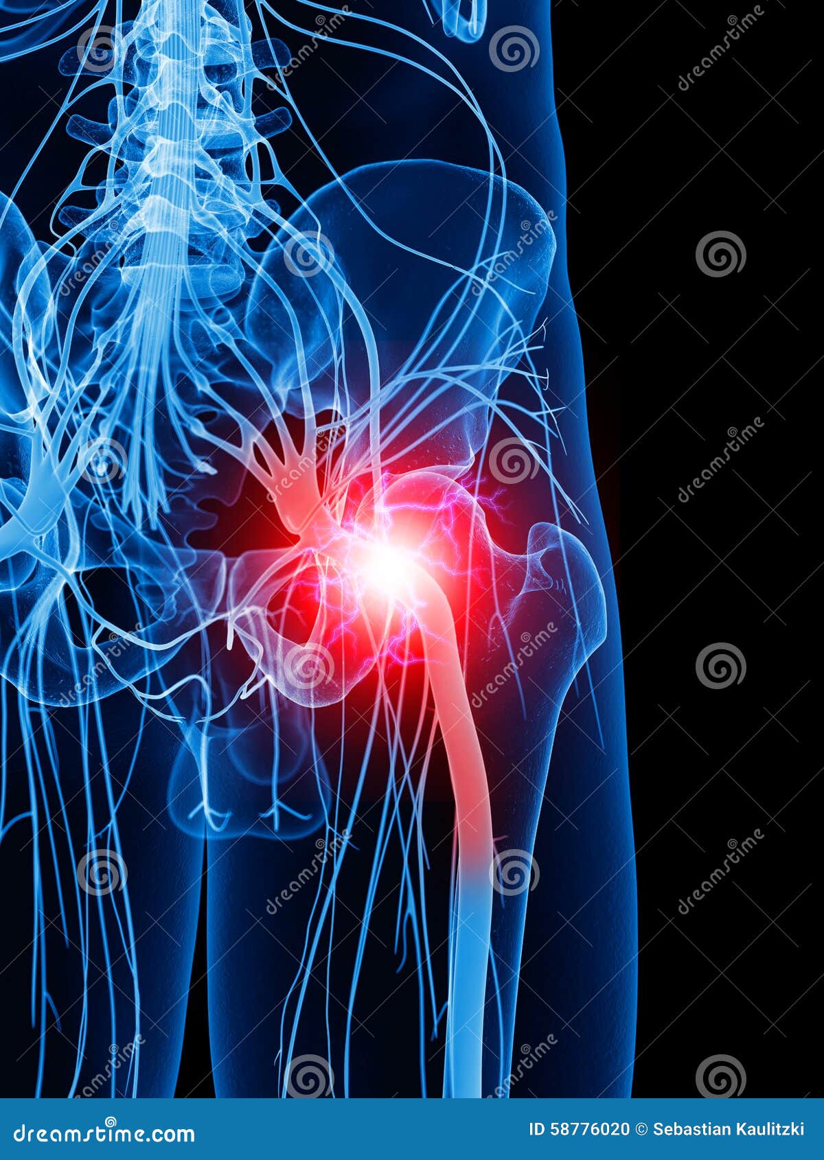 Pijnlijke heup- zenuw stock illustratie. Illustration of anatomie ...