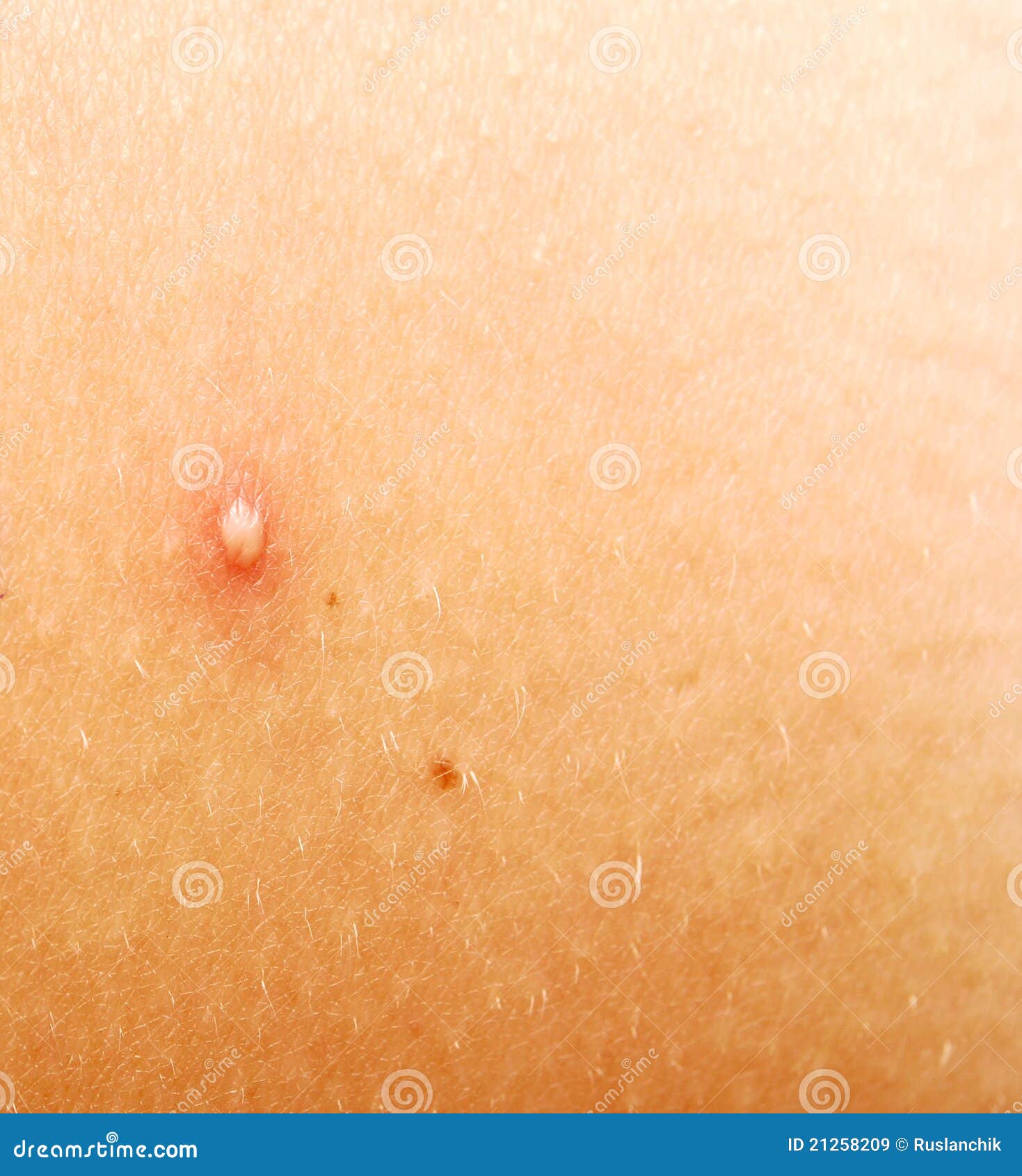 Pimple stock image. Image of detail, pink, embarrassment - 21258209