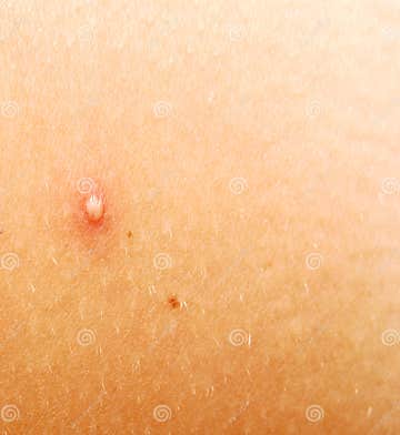 Pimple stock image. Image of detail, pink, embarrassment - 21258209