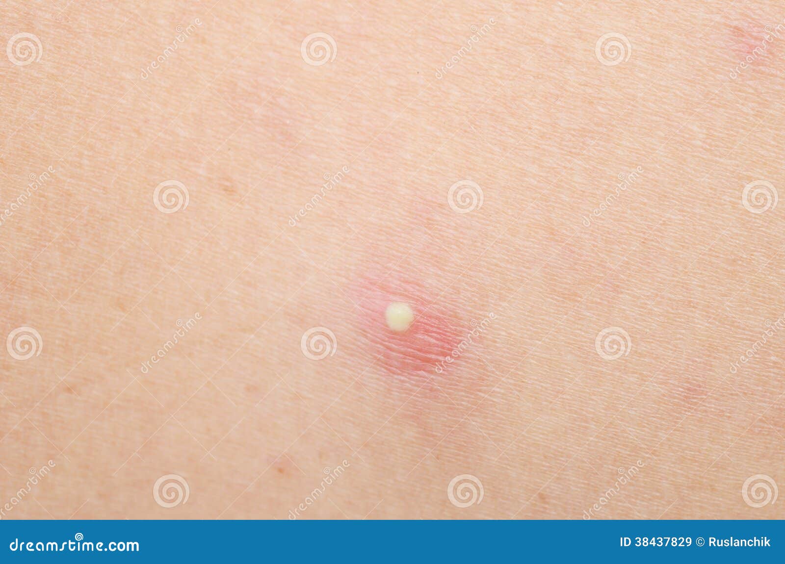 Pimple On Human Skin Macro Stock Photography | CartoonDealer.com #28587542