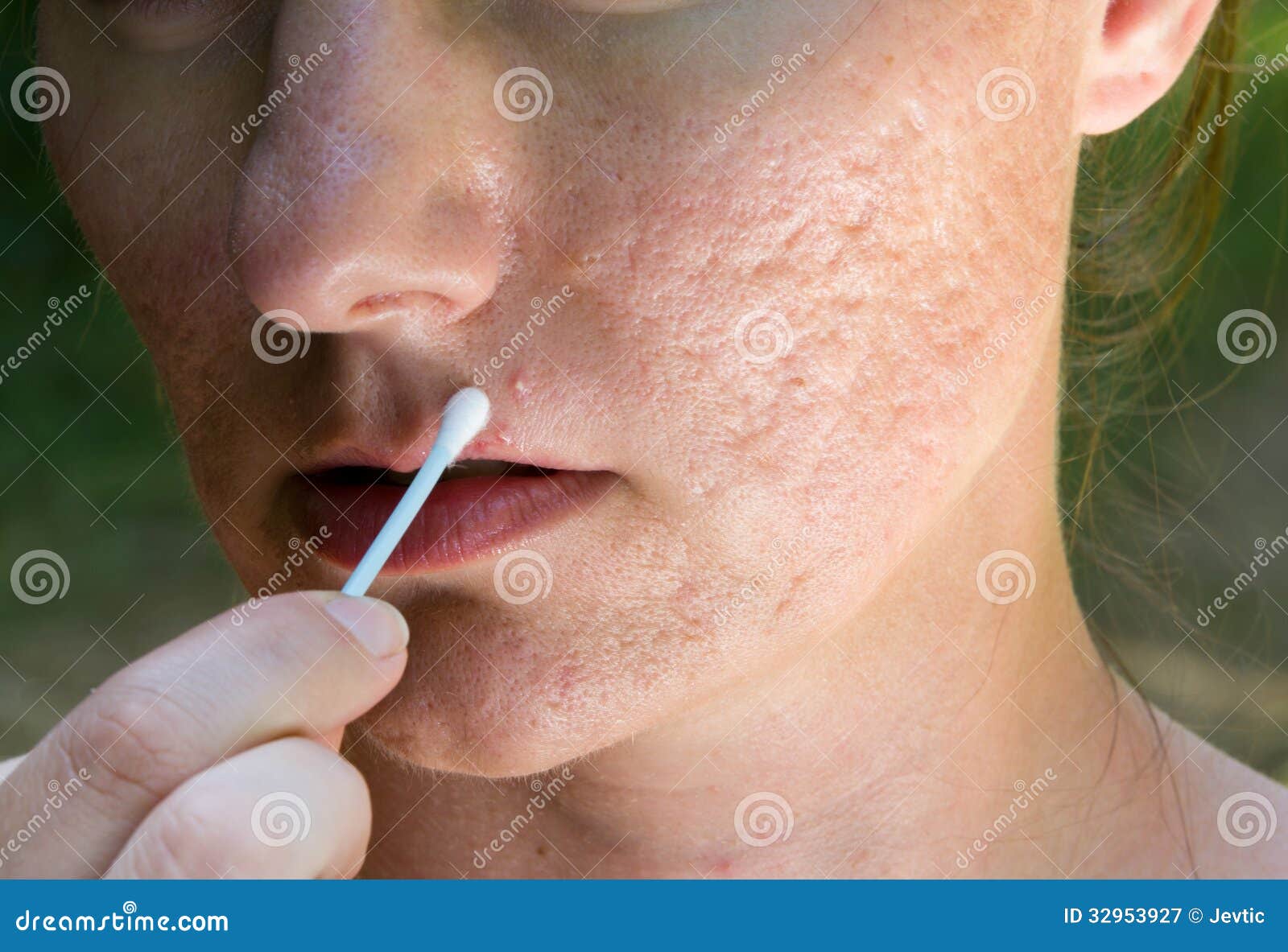 Painful Pimple Royalty-Free Stock Photo | CartoonDealer.com #19025163