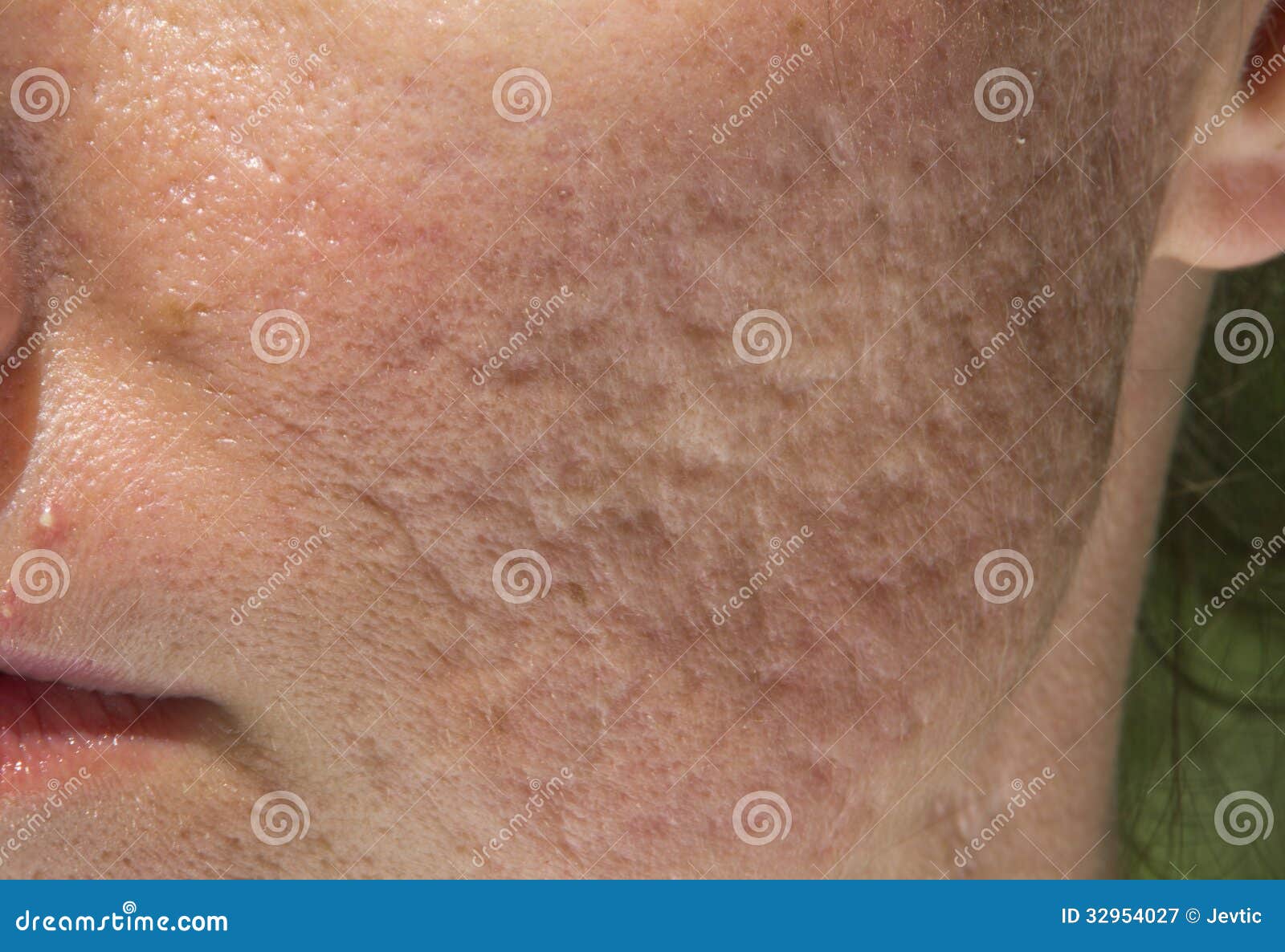 Pimple and acne scars stock image. Image of disease, beauty - 32954027