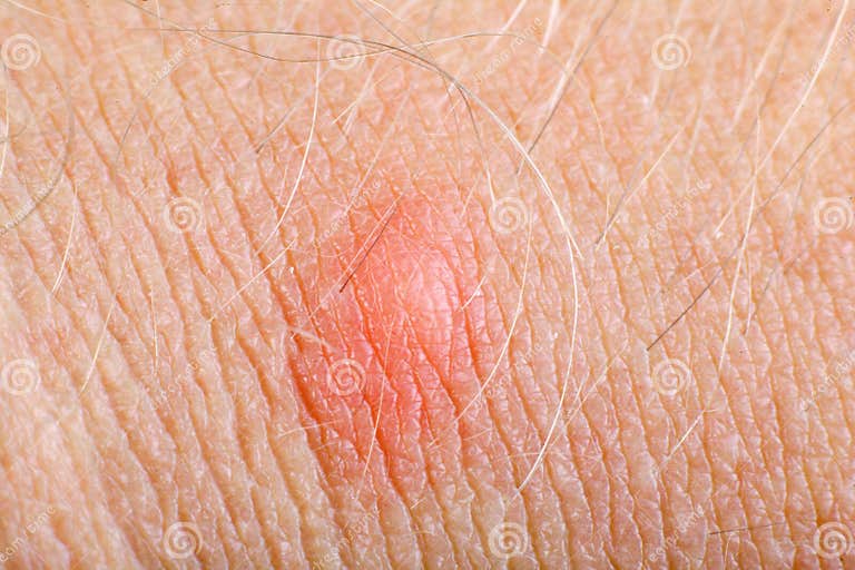 Pimple extreme macro stock photo. Image of medical, wound - 6823972
