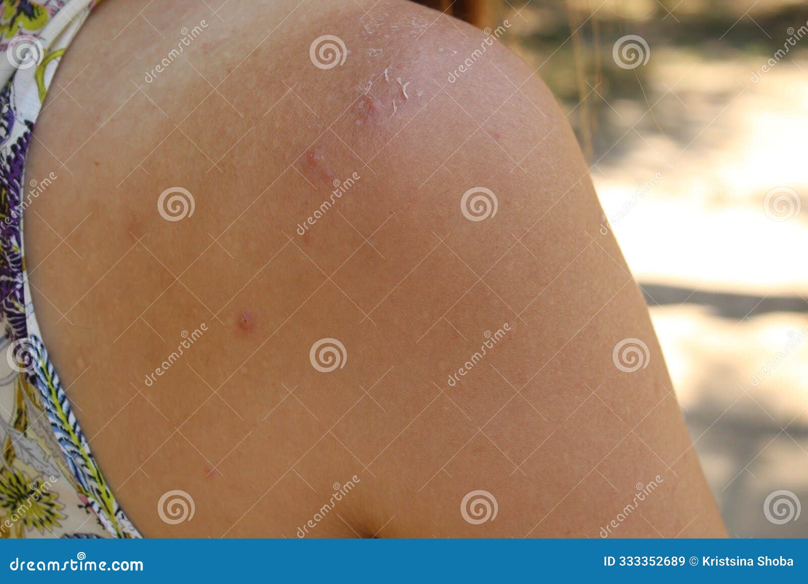 Big Red Pimple On A Man`s Back, Abscess, Close-up, Medical, Blain Stock ...