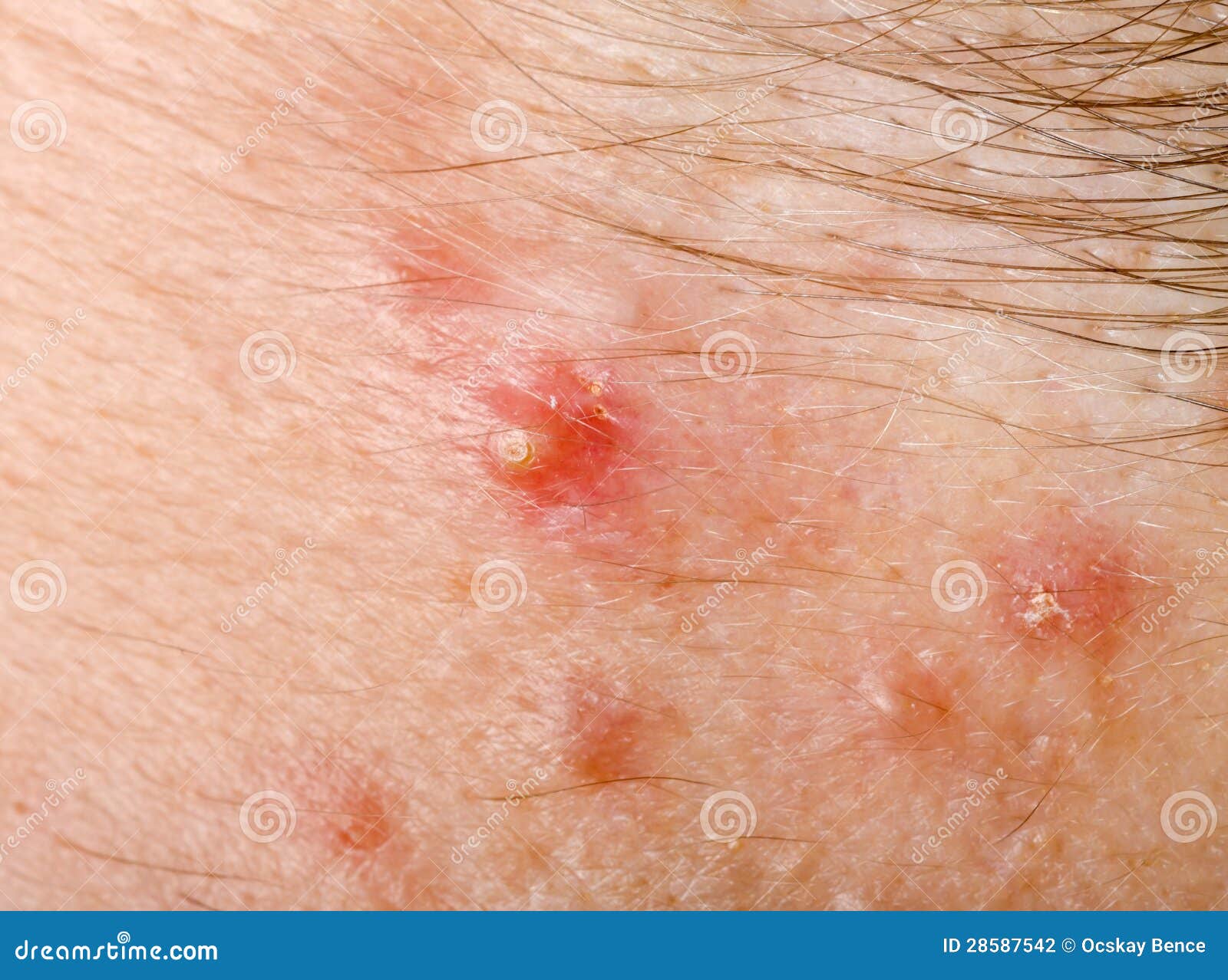 Pimple on human skin macro stock photo. Image of bacillus - 28587542